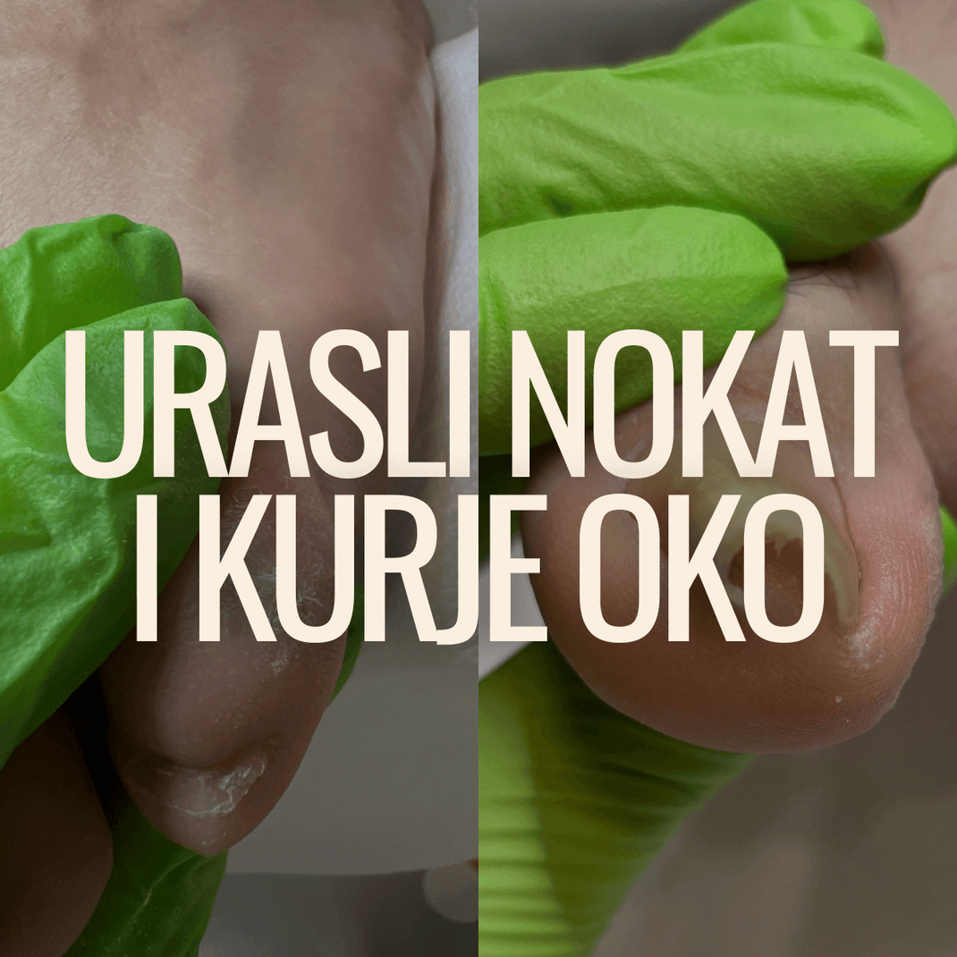 Urasli nokat i kurje oko – Tatjana Approved Shop
